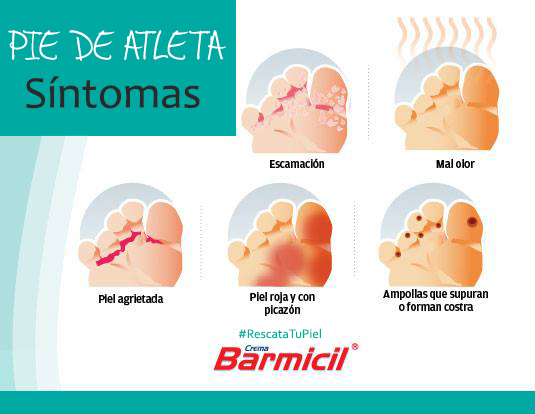 PIE DE ATLETA – Farmacia tomas tena